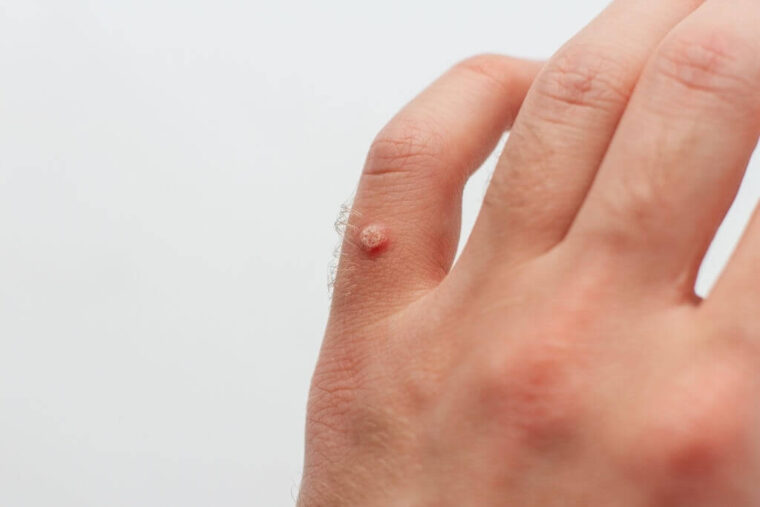 5 astuces pour se débarrasser des verrues - Mamykit